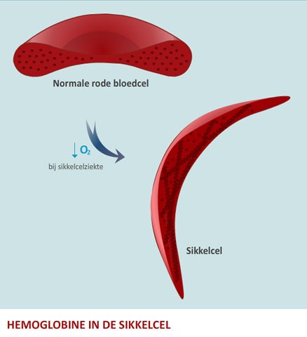 Sikkelcelziekte - CyberPoli