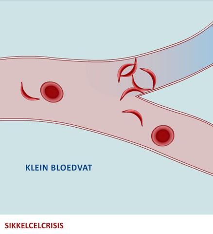 Welke problemen veroorzaakt hemoglobine S? - Medische informatie ...