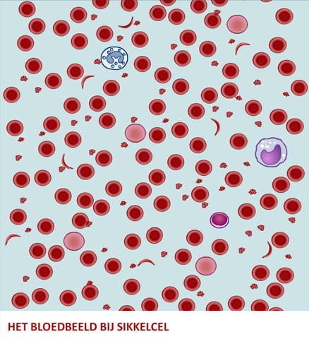 De diagnose - Medische informatie - Sikkelcelziekte - CyberPoli