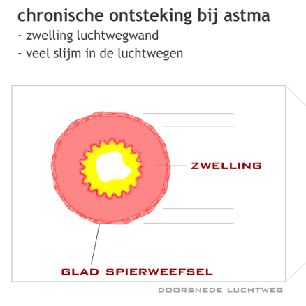 Behandeling gericht tegen ontsteking - Medische informatie - Astma ...